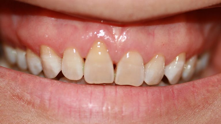 Gum Surgeries - Dental Laser Esthetics, Burnaby Dentist